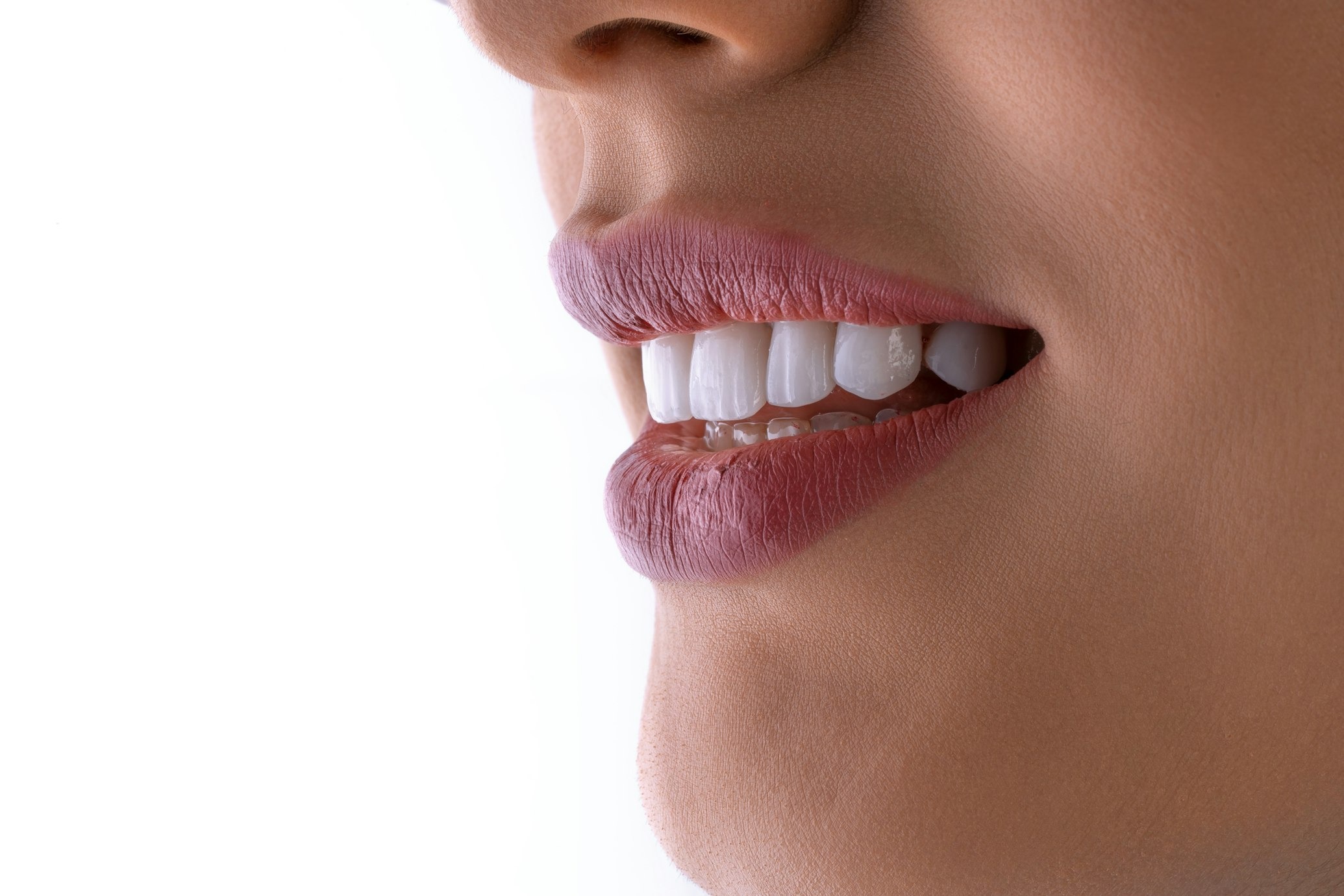 Can You Whiten Bonded Teeth? - Charles Martin DDS
