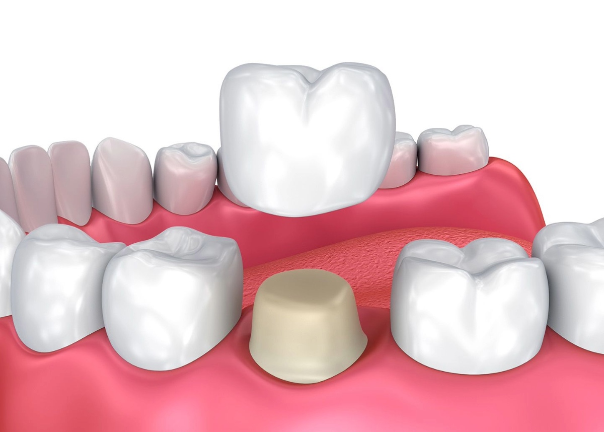 Can You Get a Dental Crown in One Visit? | Charles Martin DDS