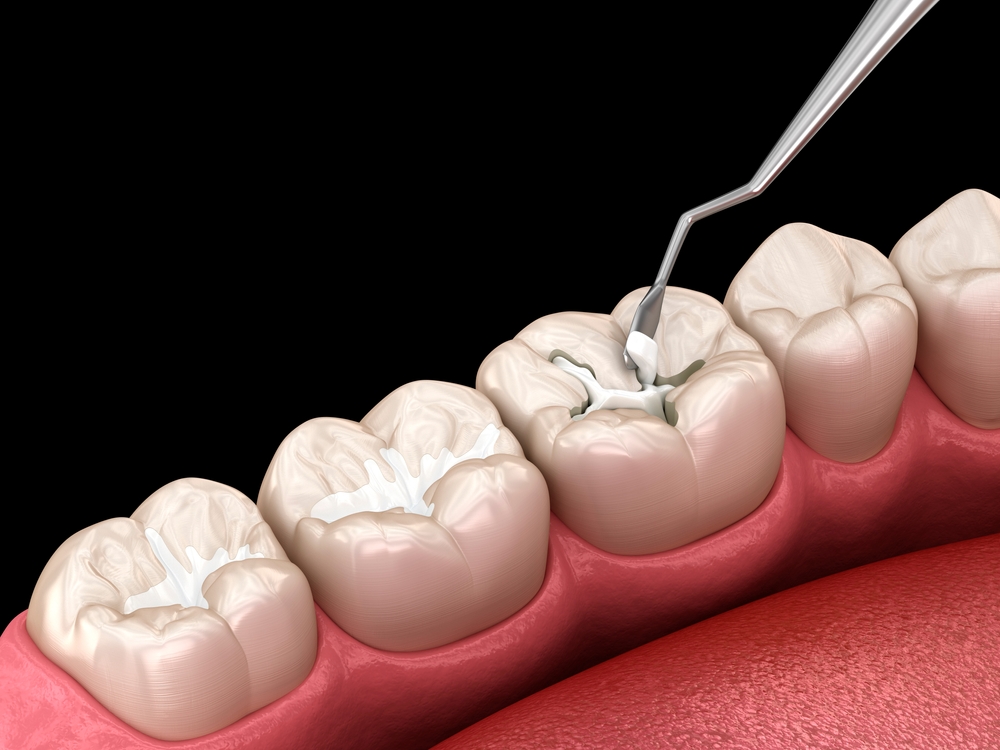 What Are Metal-Free Fillings, And Why Are They Safer?